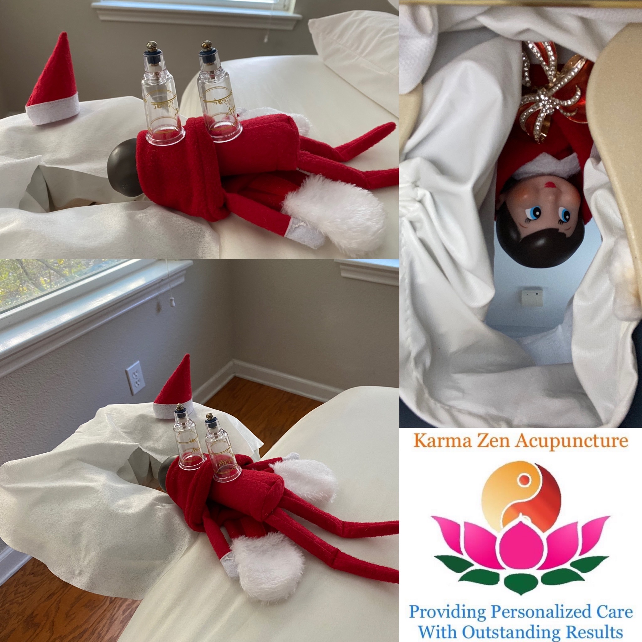 Health Benefits of Cupping Therapy - Karma Zen Acupuncture